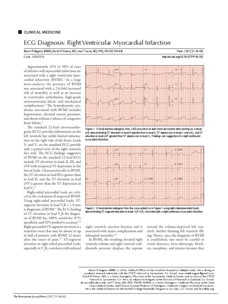 ECG Diagnosis: Right Ventricular Myocardial Infarction: Clinical ...