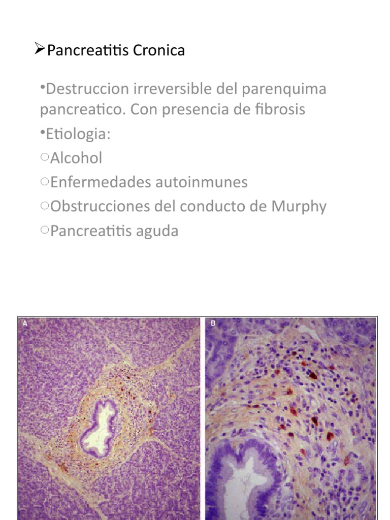 Pancreatitis Cronica | PDF