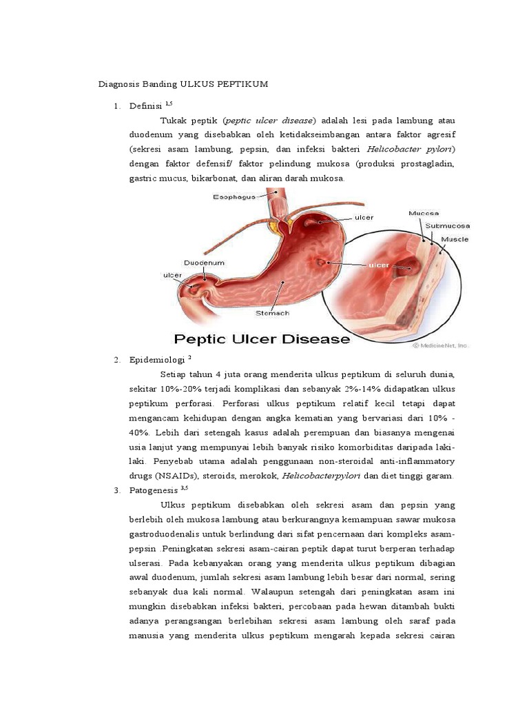 Memperjelas Diagnosis dan Penanganan Ulkus Peptikum | PDF