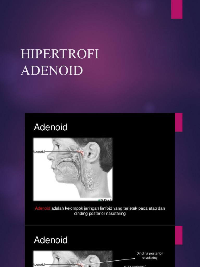 Hipertrofi Adenoid | PDF | Kesehatan Holistik | Sains & Matematika