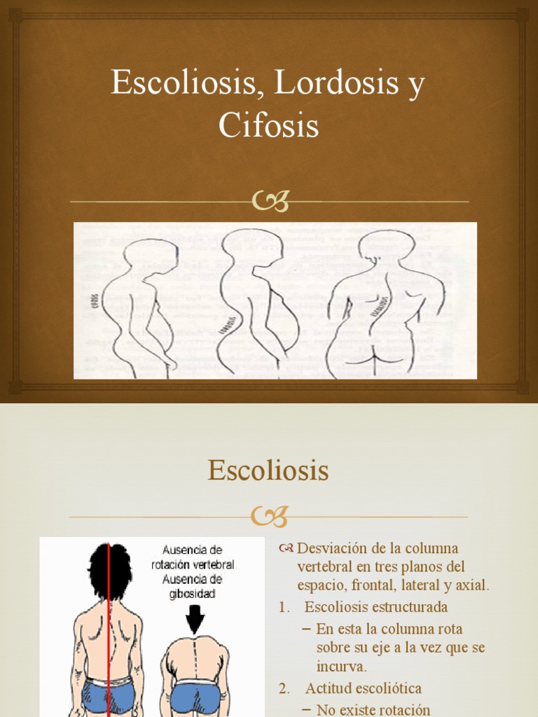 Escoliosis Lordosis y Cifosis | PDF | Escoliosis | Medicina CLINICA