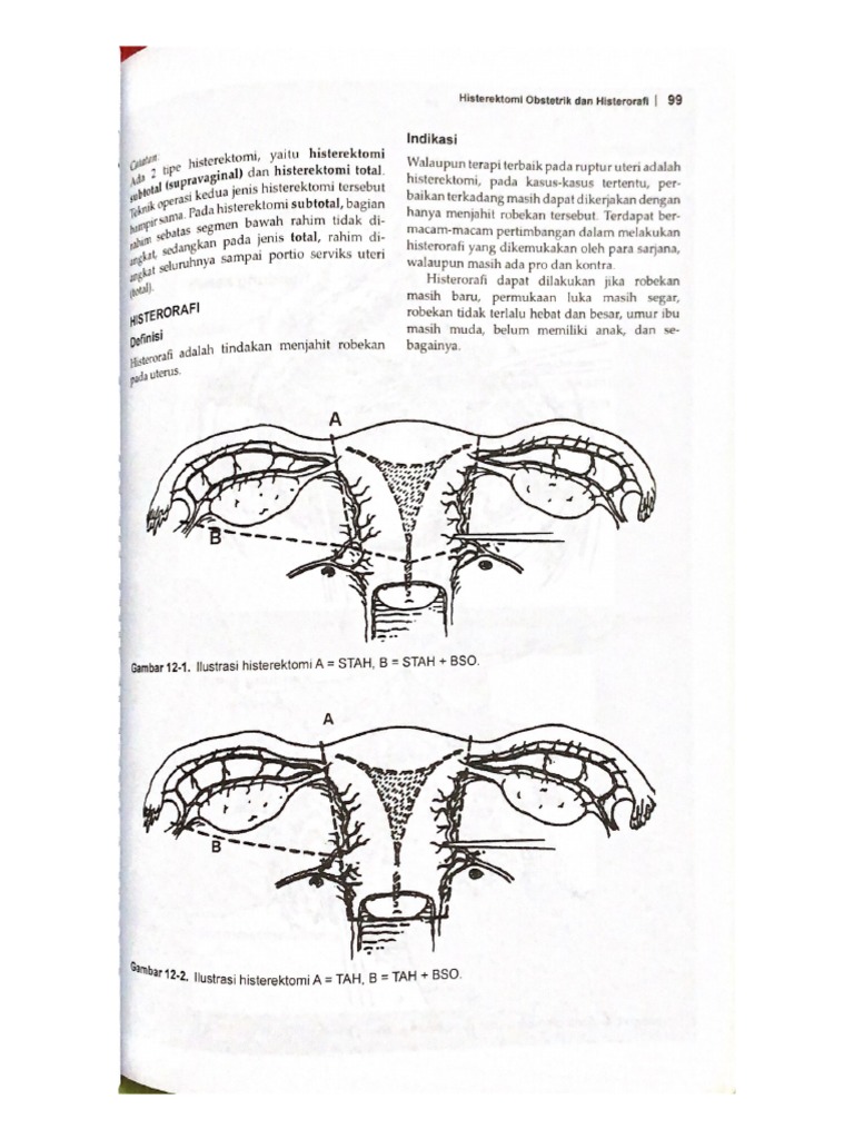 Histerektomi Obstetrik Dan Histerorafi | PDF
