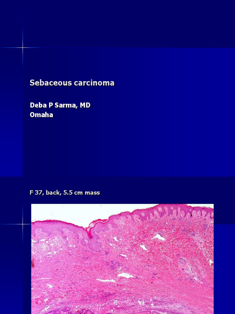 Sebaceous Carcinoma. | PDF