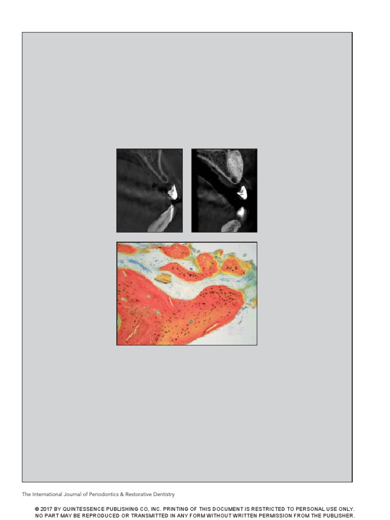 Subperiostial Minimally Invasive Aesthetic Ridge Augmentation Technique ...