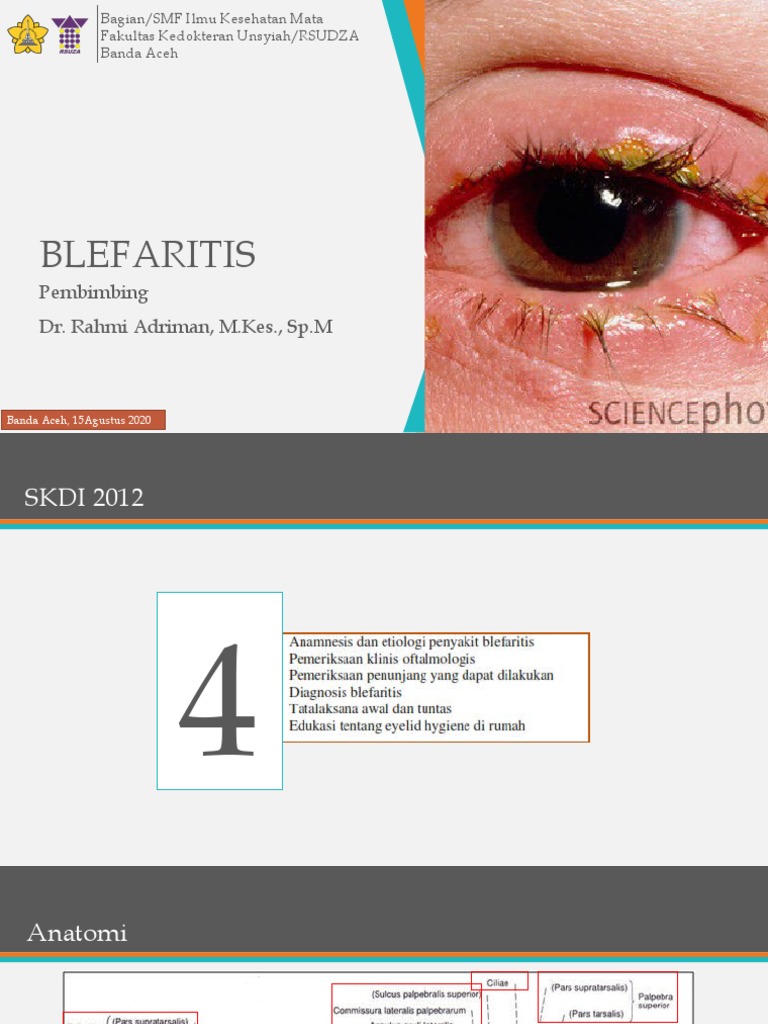 Blefaritis: Gejala, Penyebab, dan Pengobatan | PDF