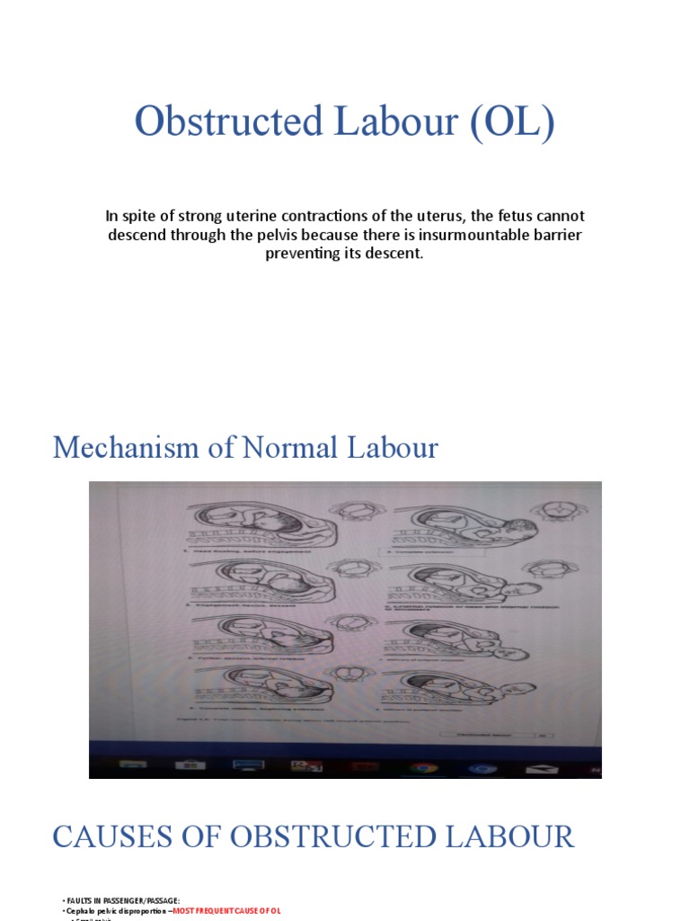 Obstructed Labour (OL) | PDF | Pelvis | Childbirth