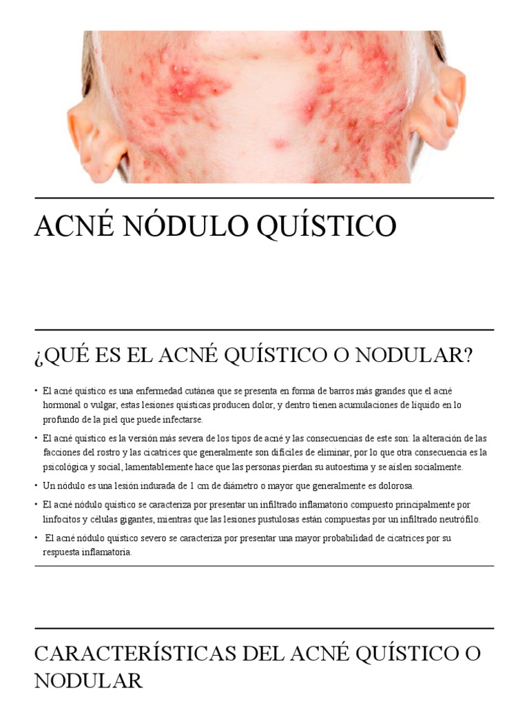 Acné Nódulo Quístico | PDF | Rtt | Ciencias de la Salud
