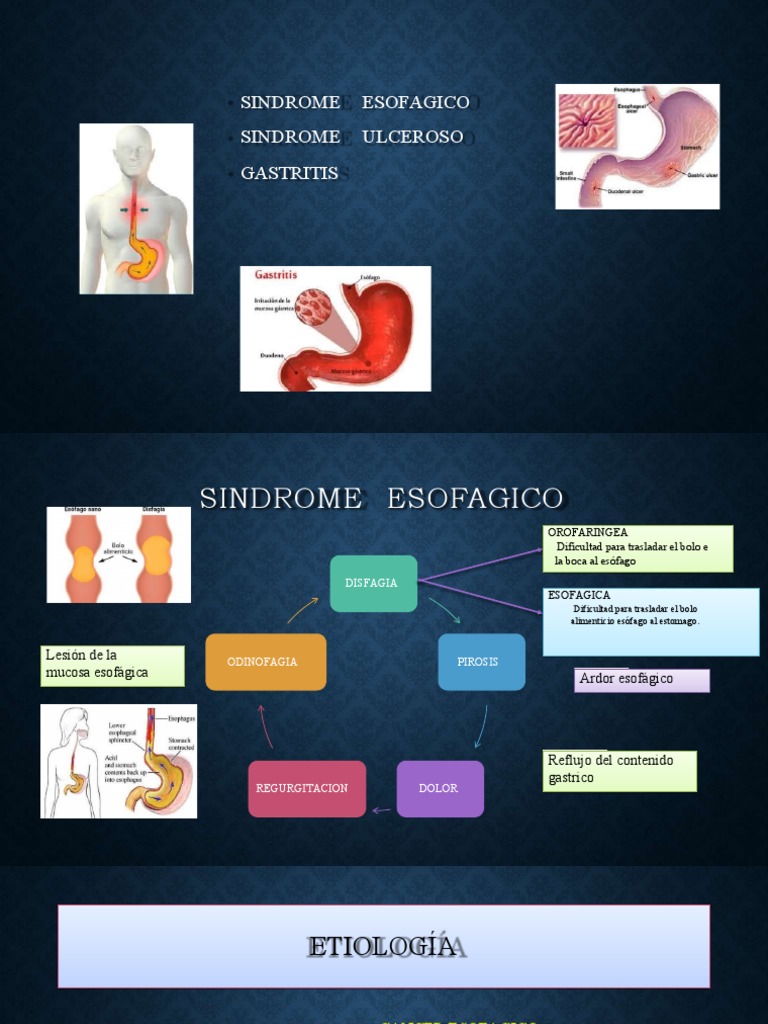 Sindrome Esofagico | PDF | Sistema digestivo | Rtt
