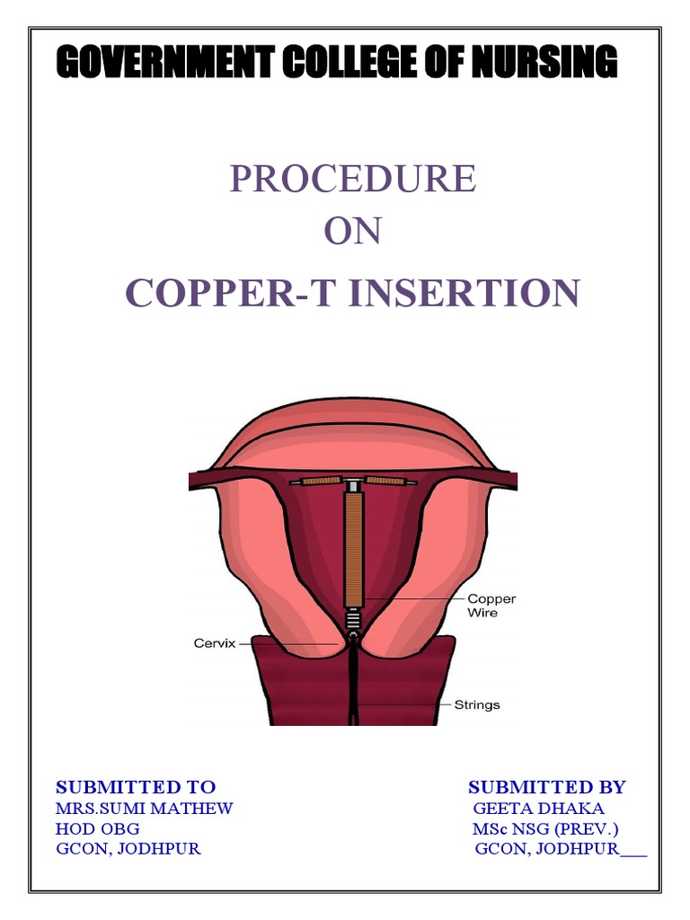 Procedure ON: Copper-T Insertion | PDF | Uterus | Vagina