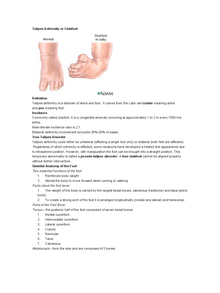 Talipes Deformity or Clubfoot | PDF | Foot | Musculoskeletal System
