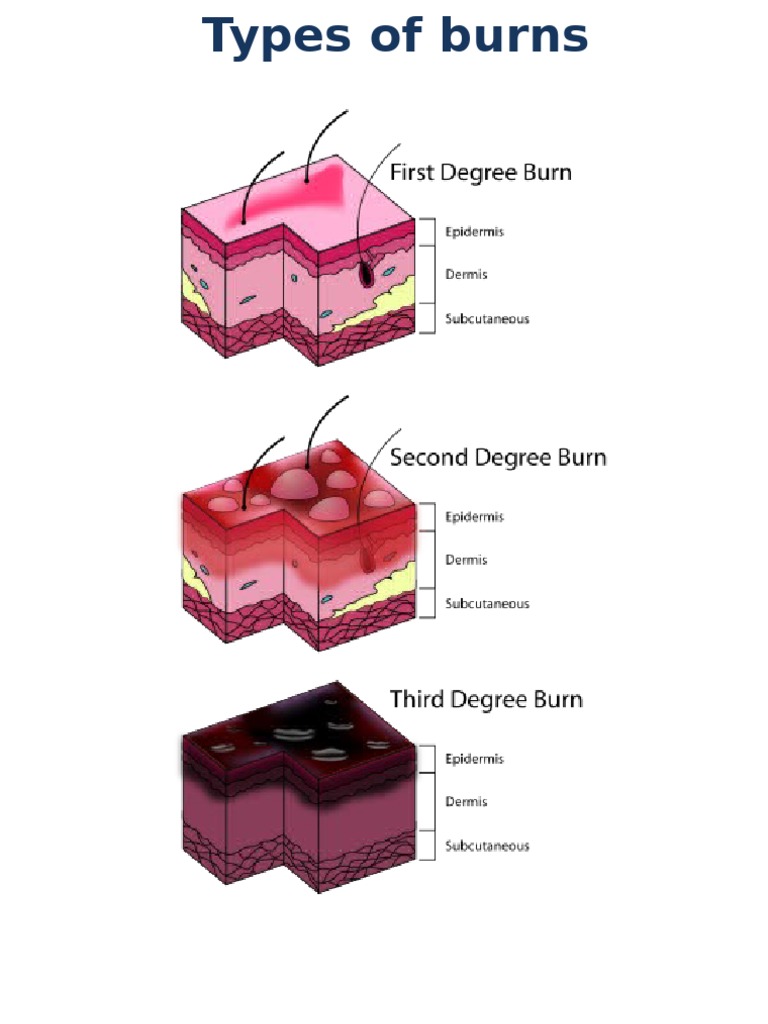 Types of Burns | PDF | Burn | Skin
