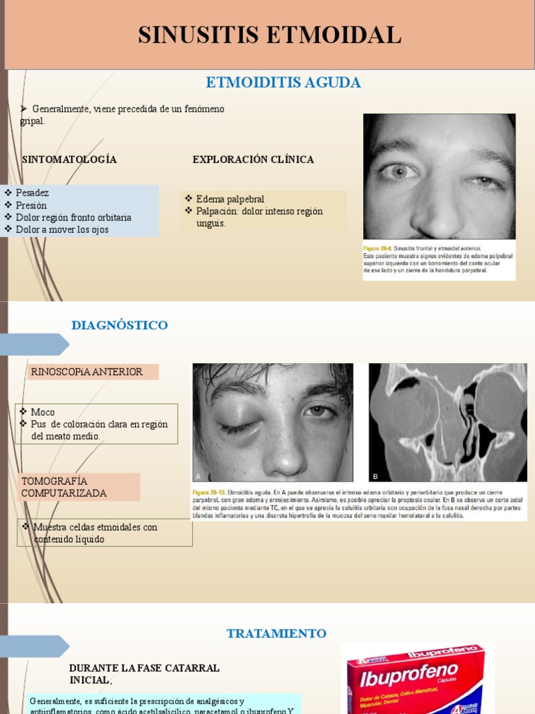Diapositivas Sinusitis Etmoidal y Esfenoidal | PDF | Dolor de cabeza ...