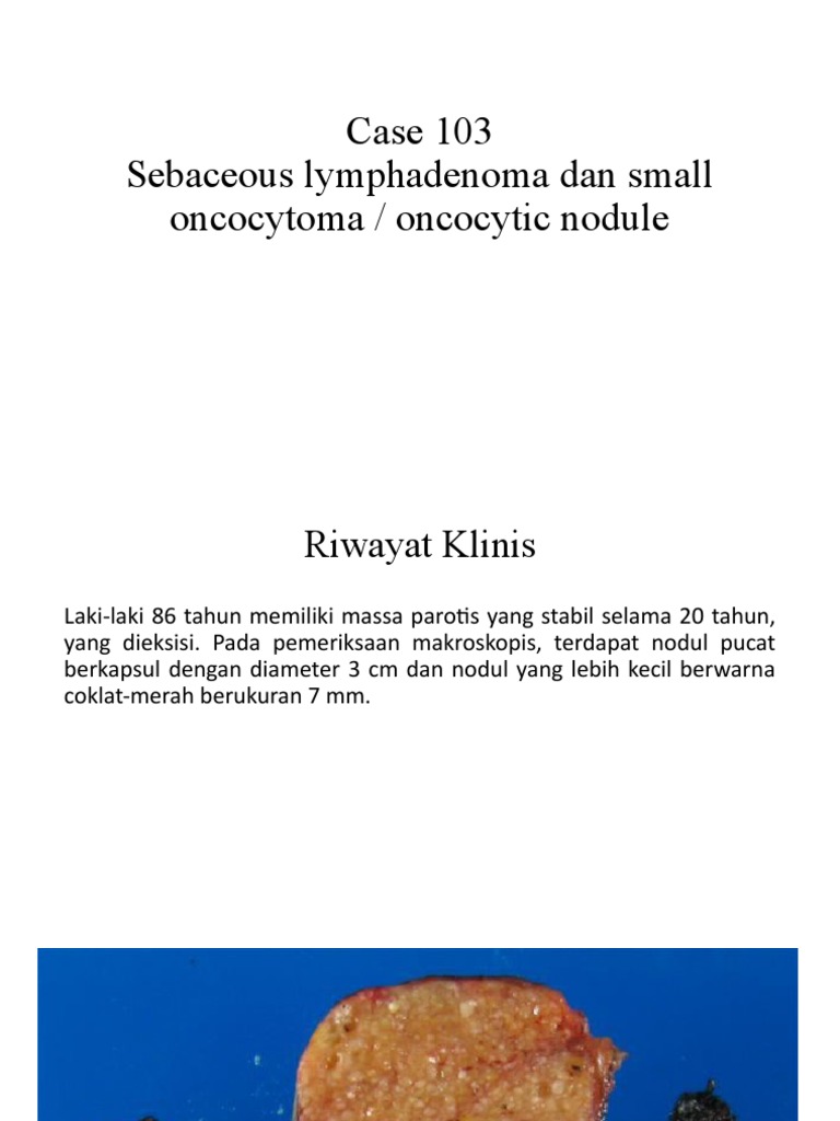 Case 103 Sebaceous Lymphadenoma Dan Small Oncocytoma Atau Oncocytic ...