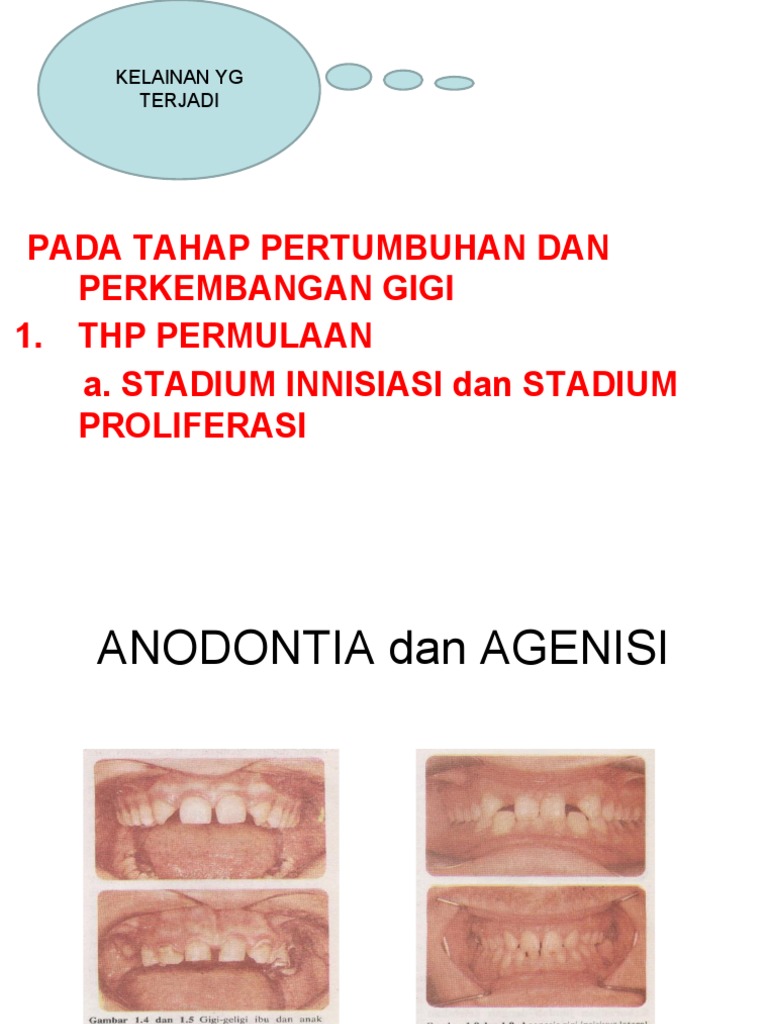 Kelainan Pada Tahap Pertumbuhan Gigi | PDF