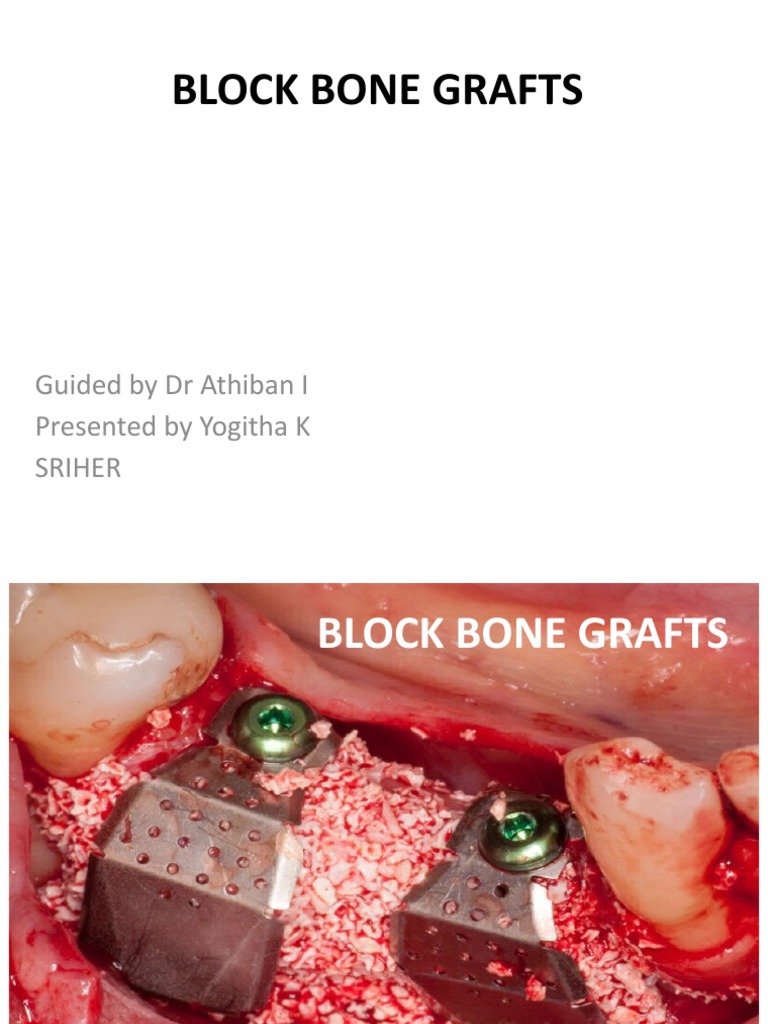 Block Bone Grafts: Techniques & Evaluation | PDF | Dental Implant | Bone