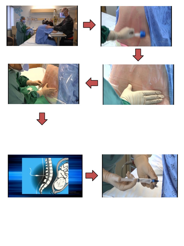 Bupivacaine in Epidural Anesthesia | PDF