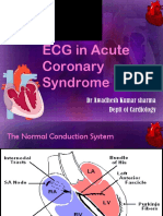 Ecg Interpretation J Point Stemi Criteria Equivalents and Others | PDF ...