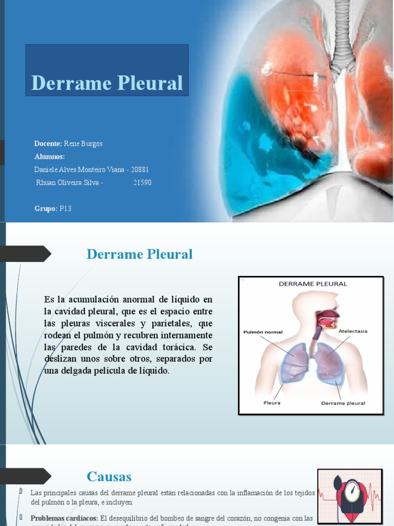Derrame Pleural | PDF