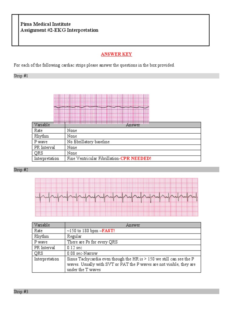 EKG Interpretation Assignment Guide | PDF | Cardiac Arrhythmia | Physiology