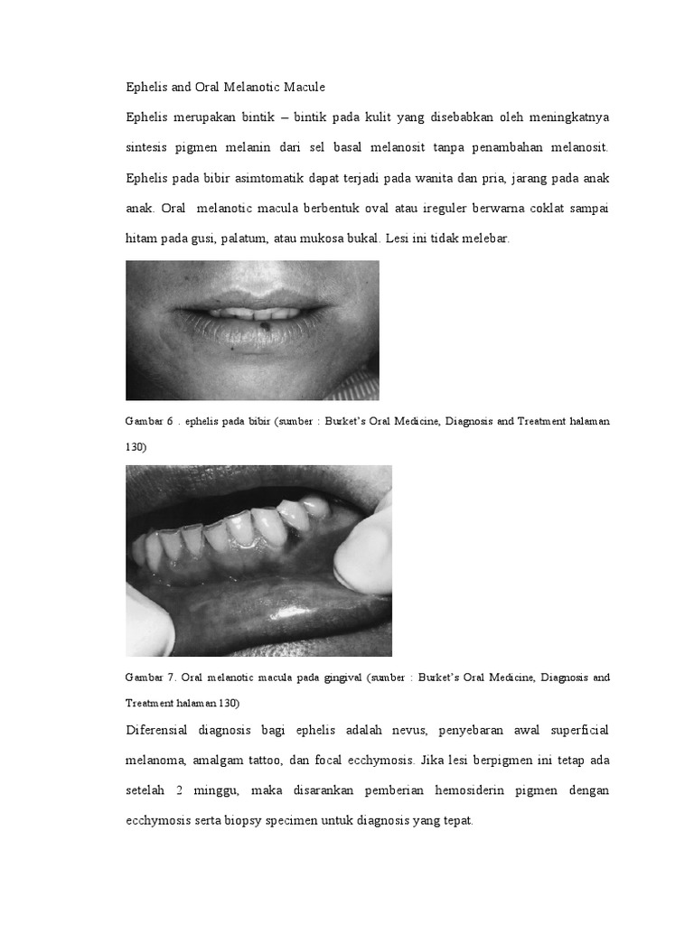 Ephelis and Oral Melanotic Macule | PDF