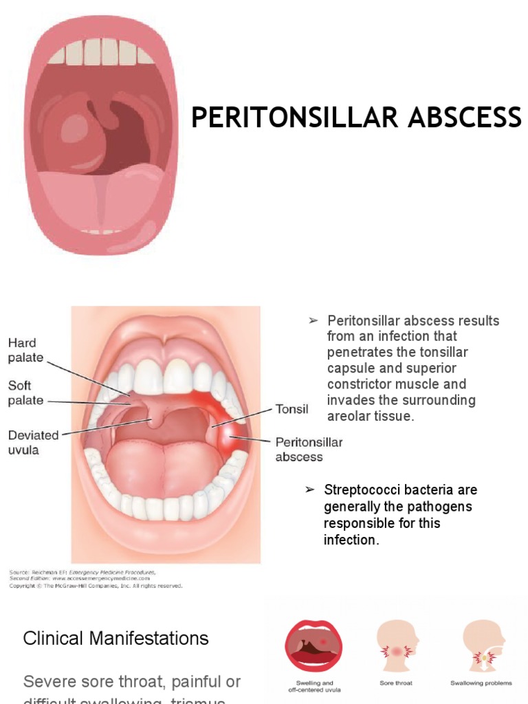 Peritonsillar Abscess Incision And Drainage