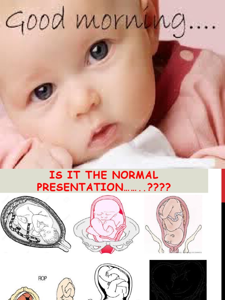 Malposition & Malpresentation | PDF | Midwifery | Childbirth