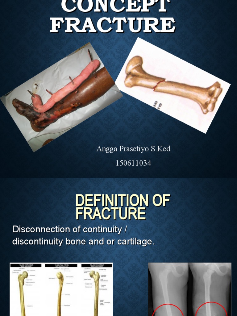 A Comprehensive Overview of Bone Fracture Classification, Treatment ...