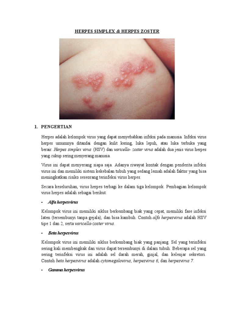 Herpes Simplex & Herpes Zoster - Selesai | PDF