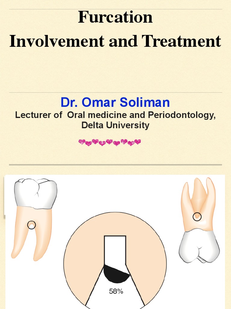 Furcation Involvement: Diagnosis, Classification, Factors Affecting ...
