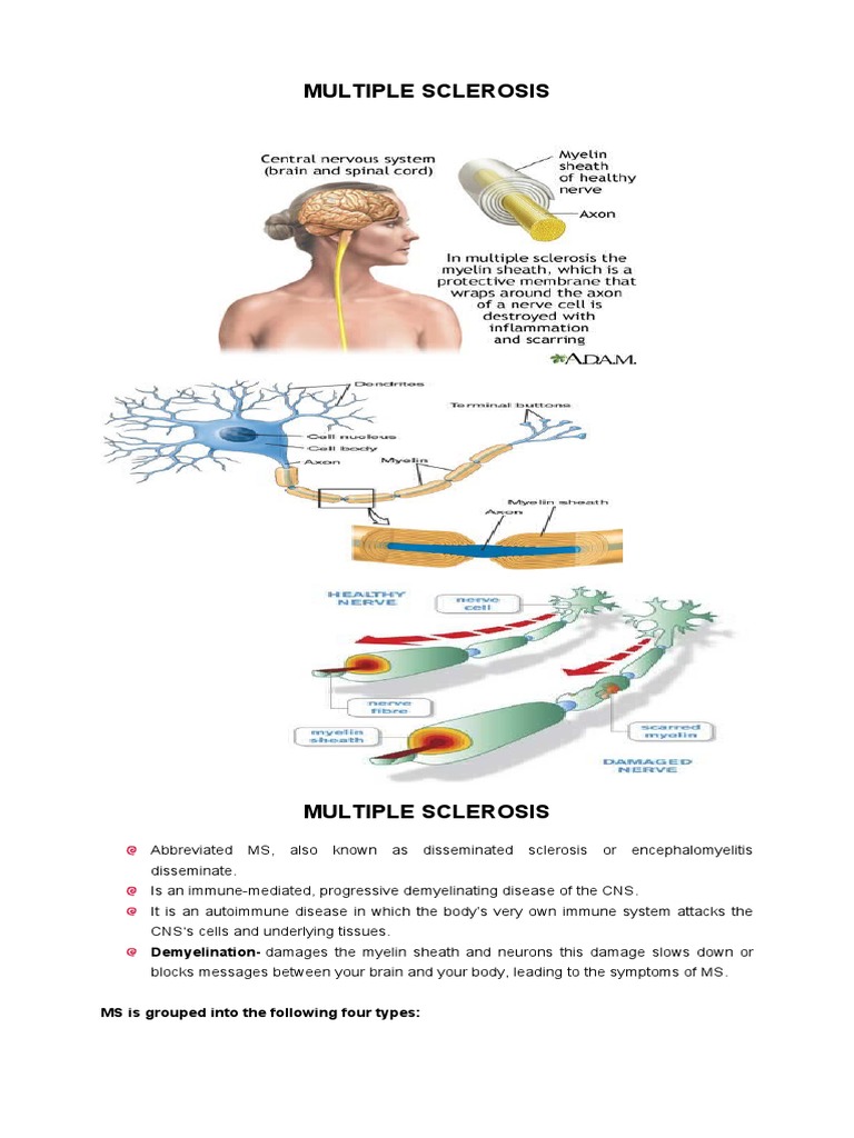 Multiple Sclerosis Overview & Management | PDF | Multiple Sclerosis ...