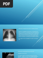 Signos Radiológicos Neumoperitoneo | PDF