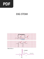 Gambaran EKG pada STEMI dan Normal | PDF