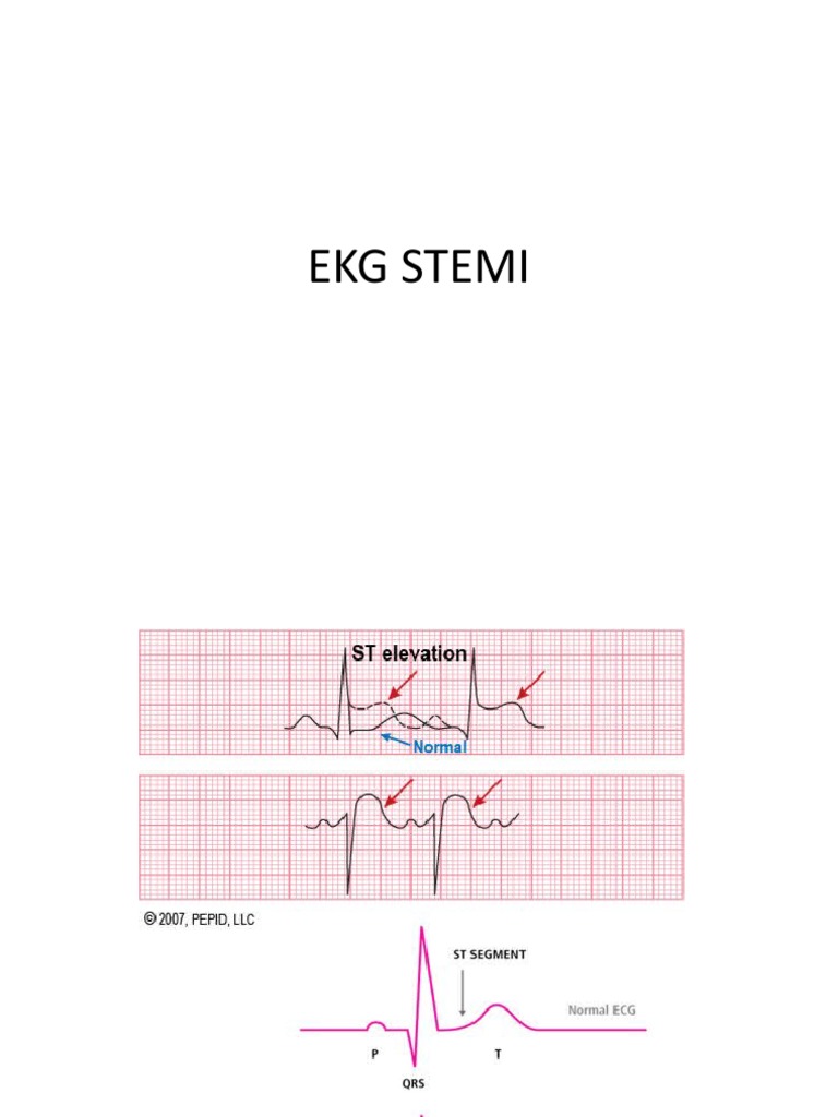 Ekg Stemi | PDF