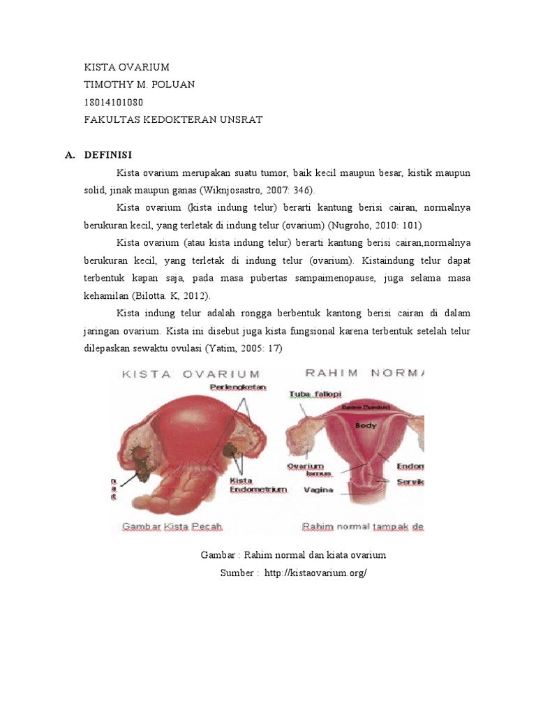 Kista Ovarium | PDF