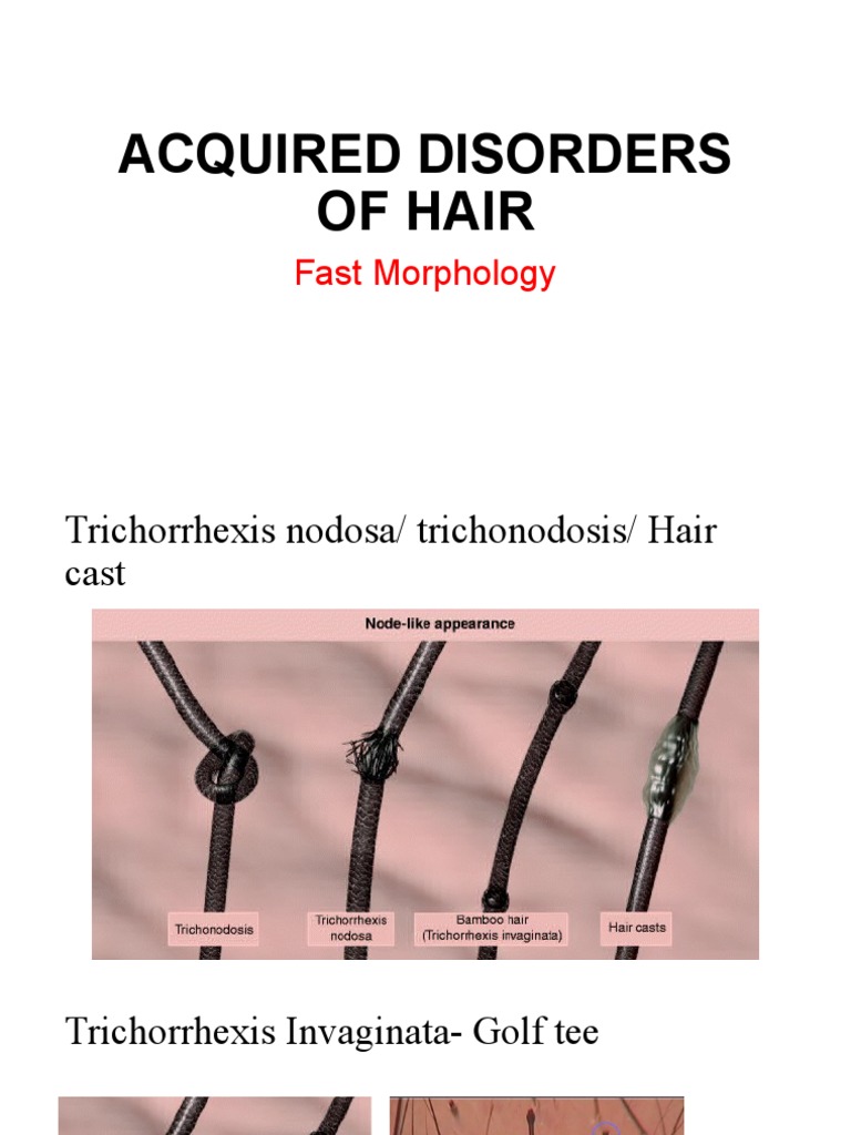 Acquired Hair Shaft Disorders Overview | PDF