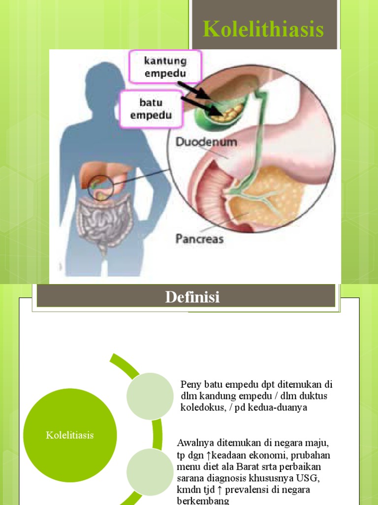 Panduan Lengkap Kolelitiasis dan Tatalaksana | PDF