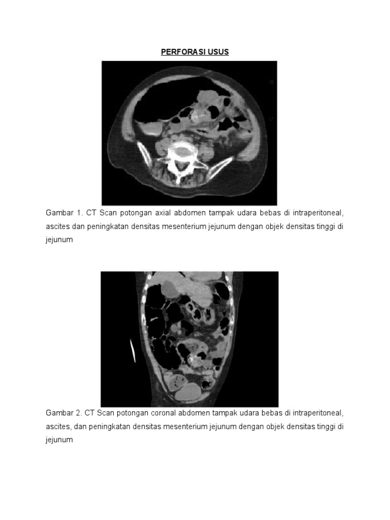 Perforasi Usus | PDF
