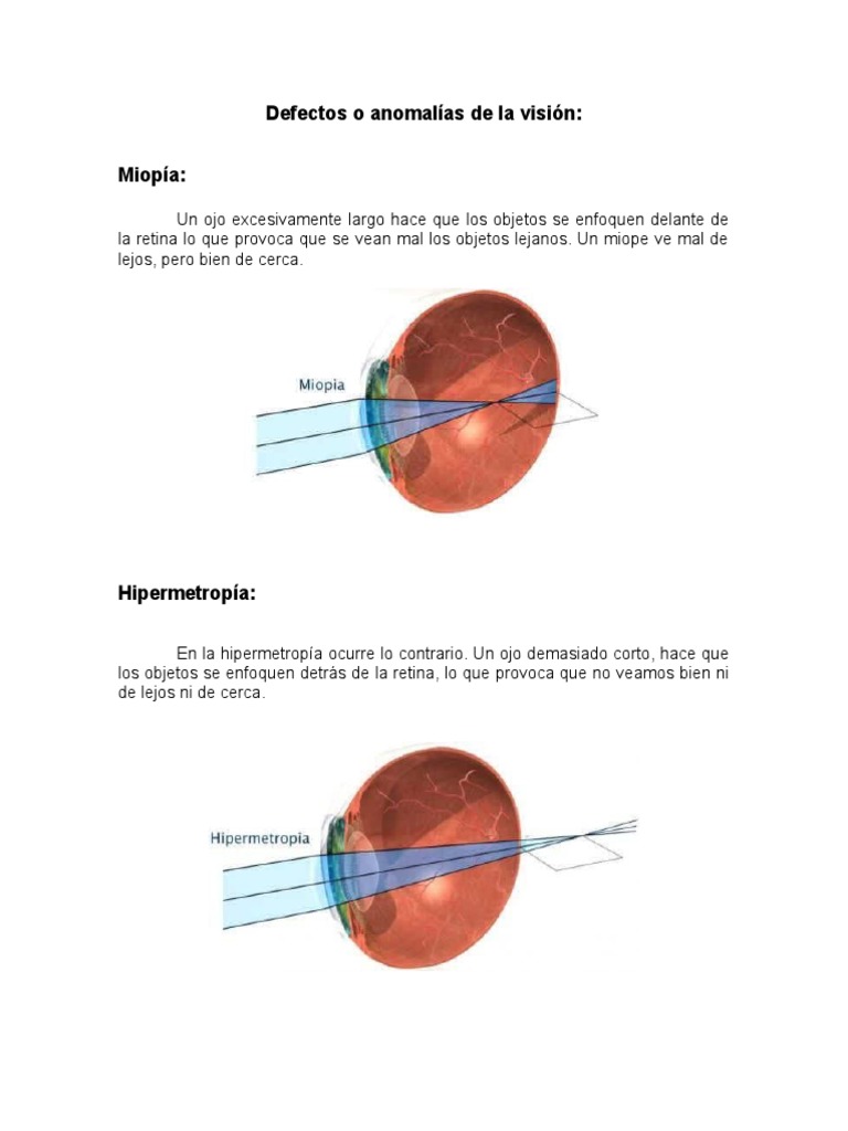 Defectos o Anomalías de La Visión | PDF