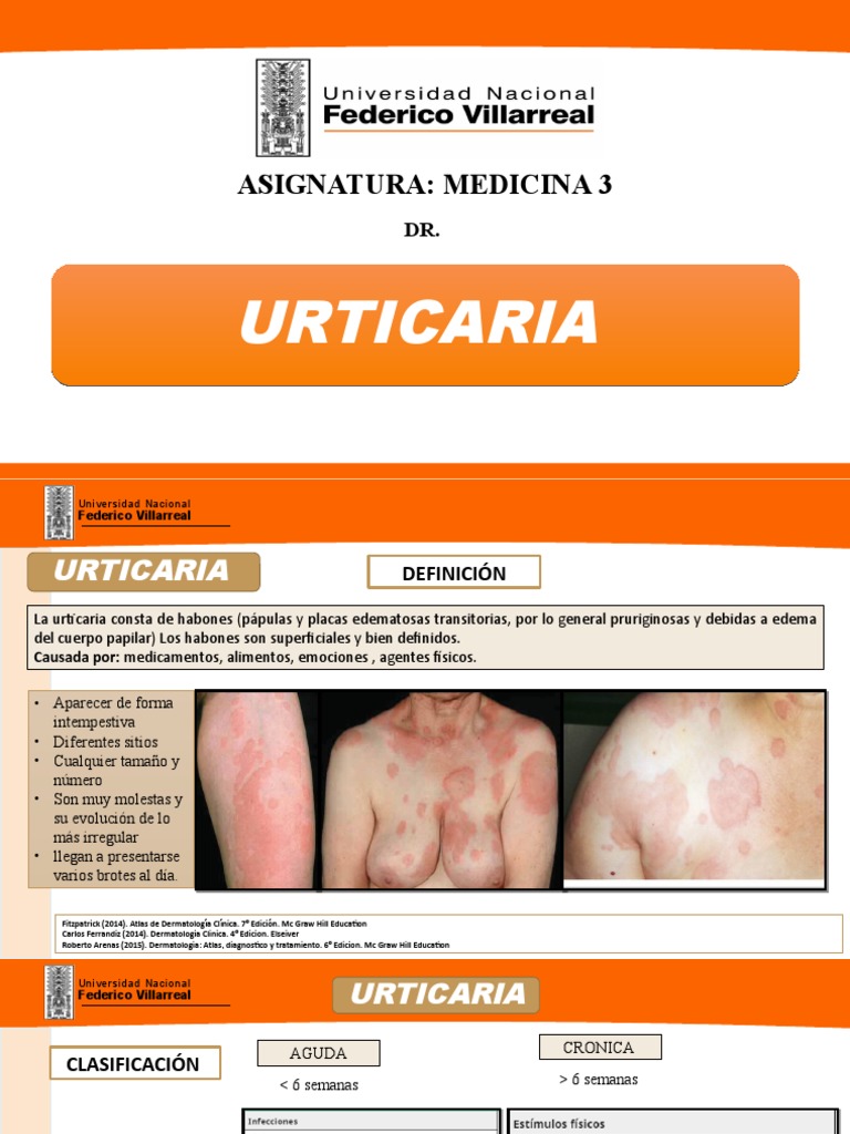 URTICARIA | PDF | Alergia | Especialidades Medicas