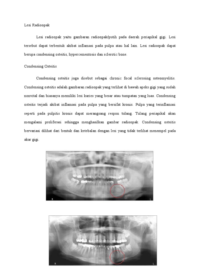 Lesi Radioopak Condensing Osteitis | PDF | Sains & Matematika