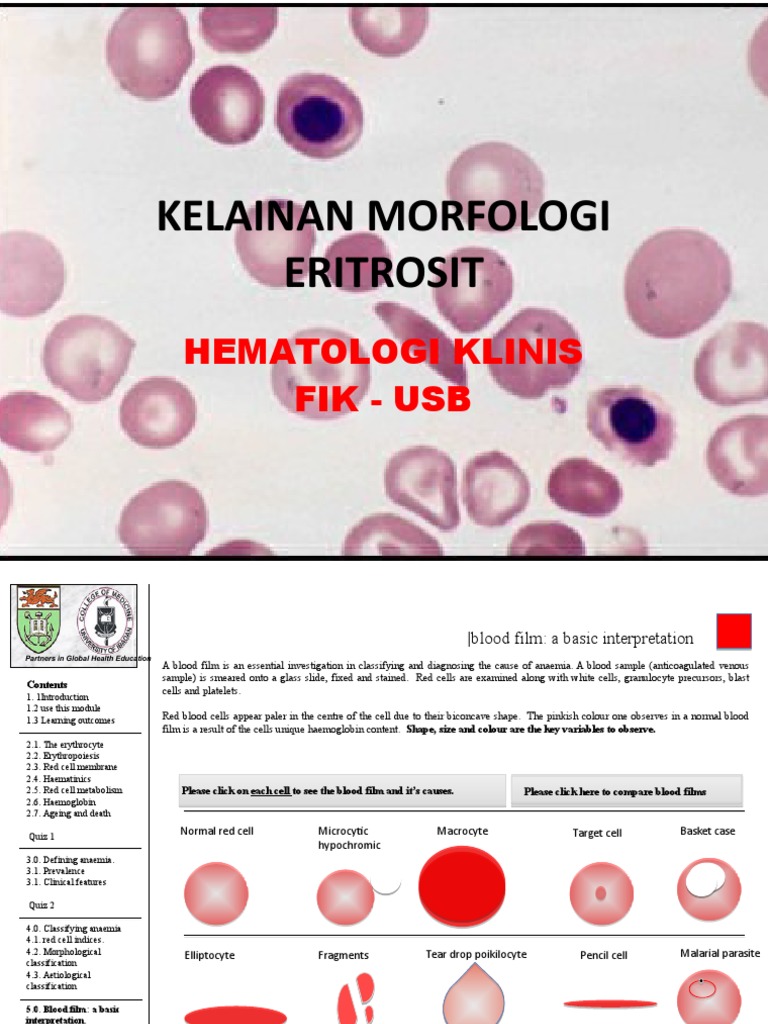 Kelainan Morfologi Eritrosit | PDF | Anemia | Red Blood Cell