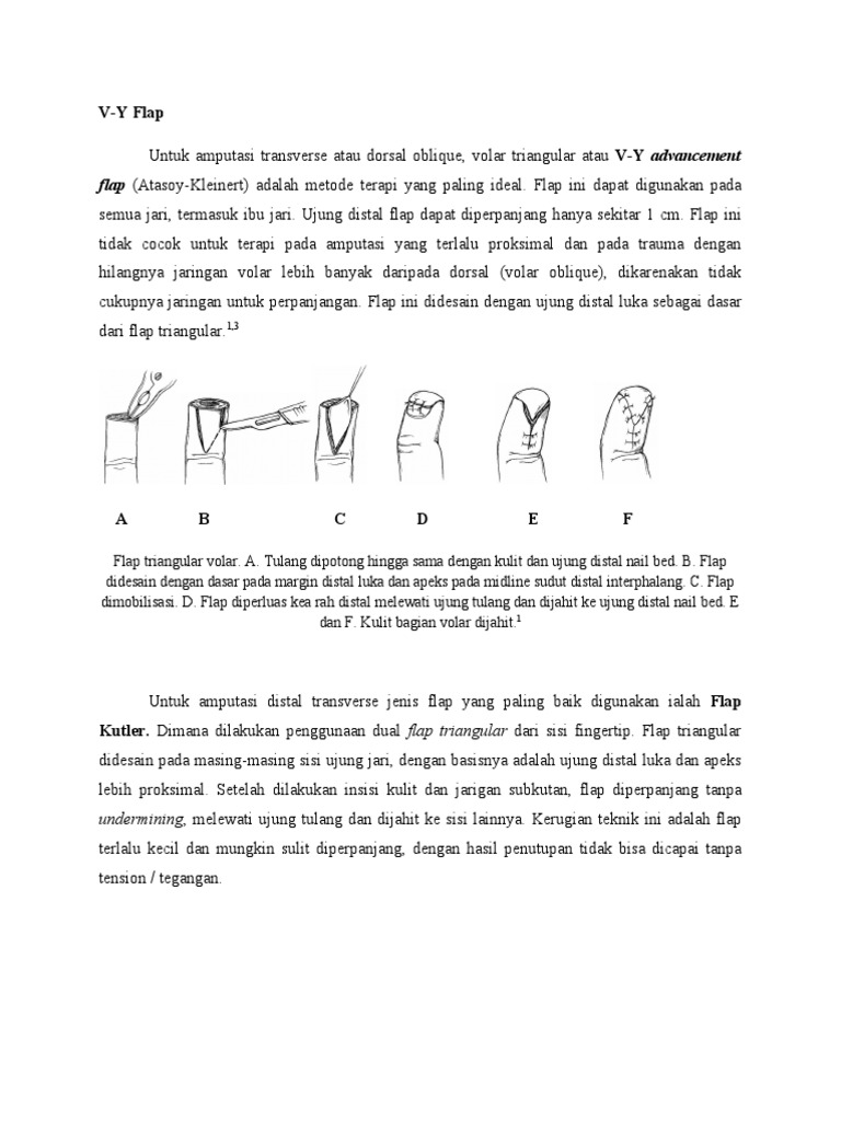Teknik V-Y Flap untuk Amputasi Jari Tangan | PDF