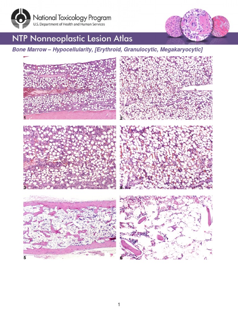 Bone Marrow-Hypocellularity 508 | PDF | Bone Marrow | Haematopoiesis