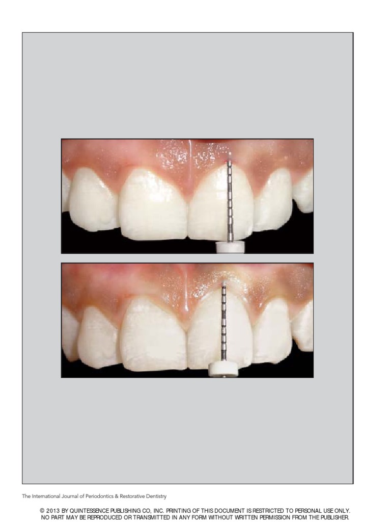 The International Journal of Periodontics & Restorative Dentistry | PDF ...