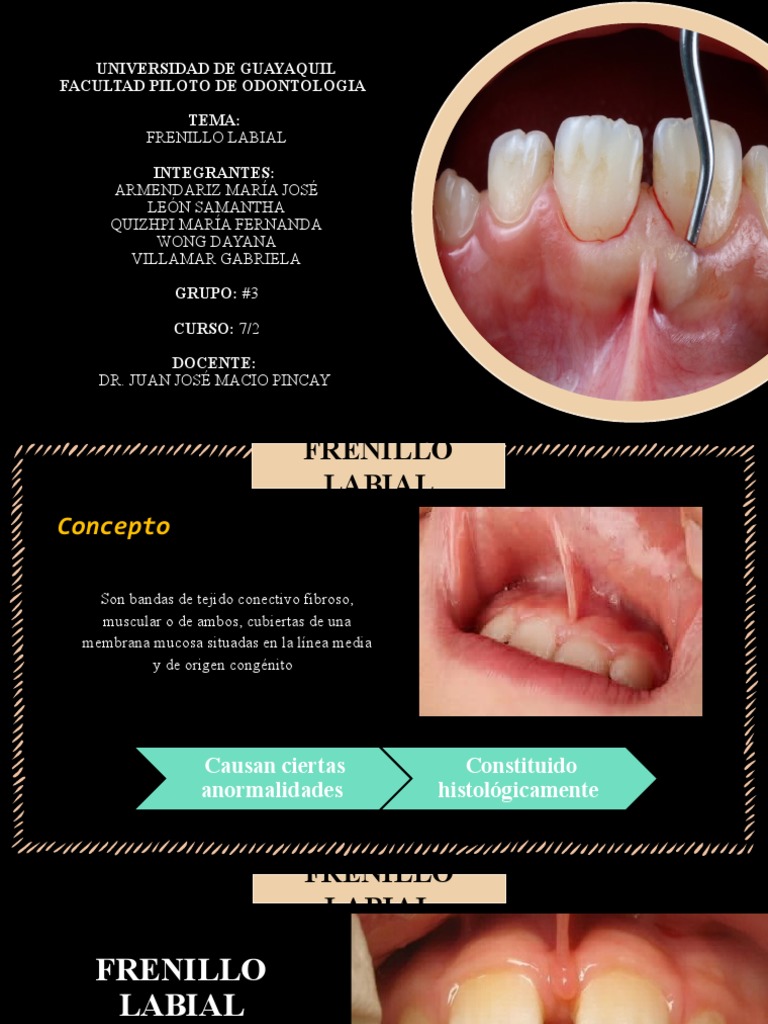 Grupo 3 - Frenillo Labial | Descargar gratis PDF | Cabeza y cuello ...