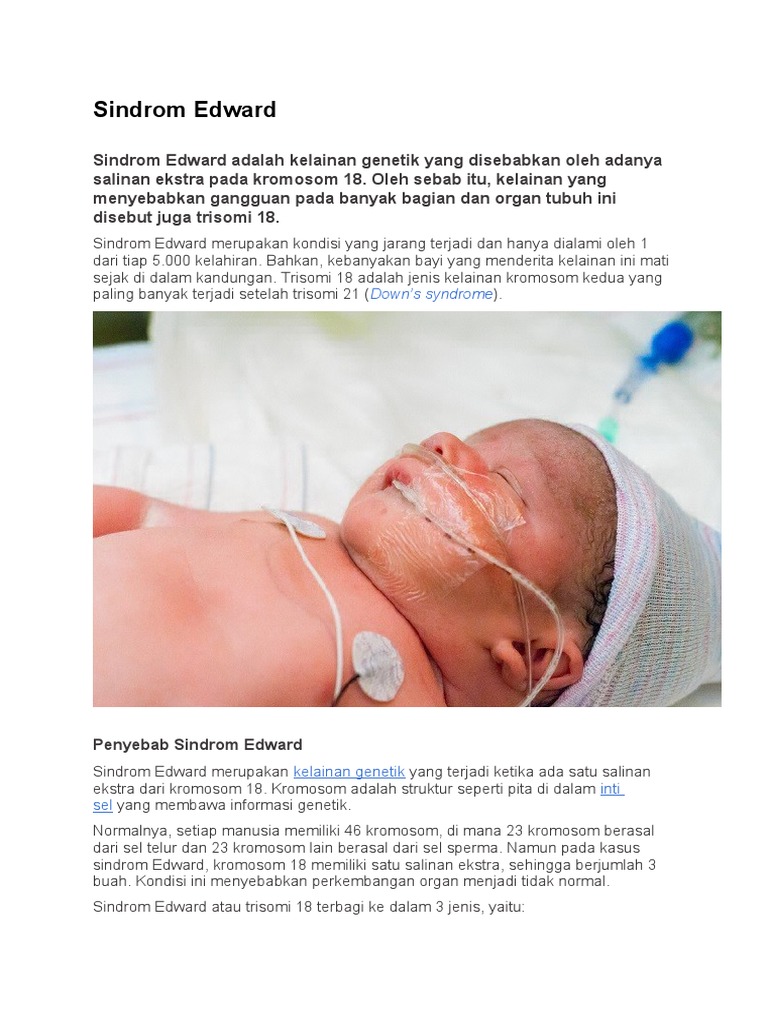 Sindrom Edward | PDF