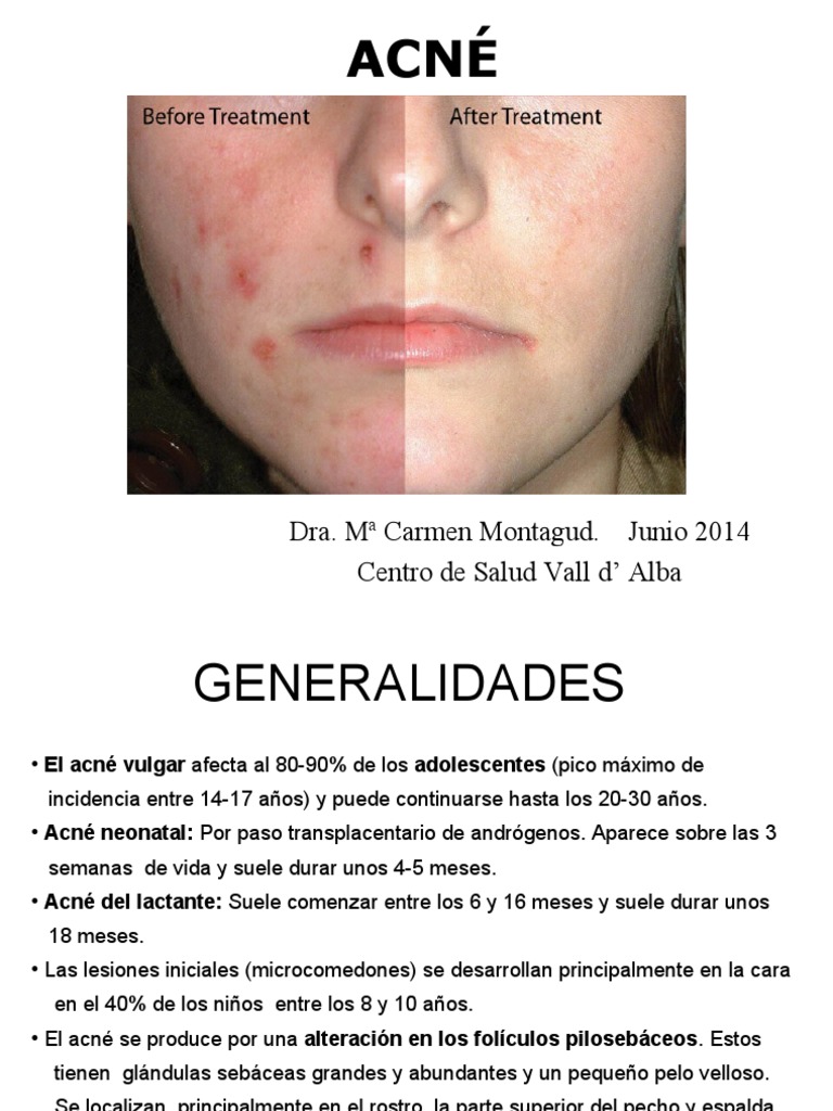 Acne | PDF | Sistema tegumentario | Medicina