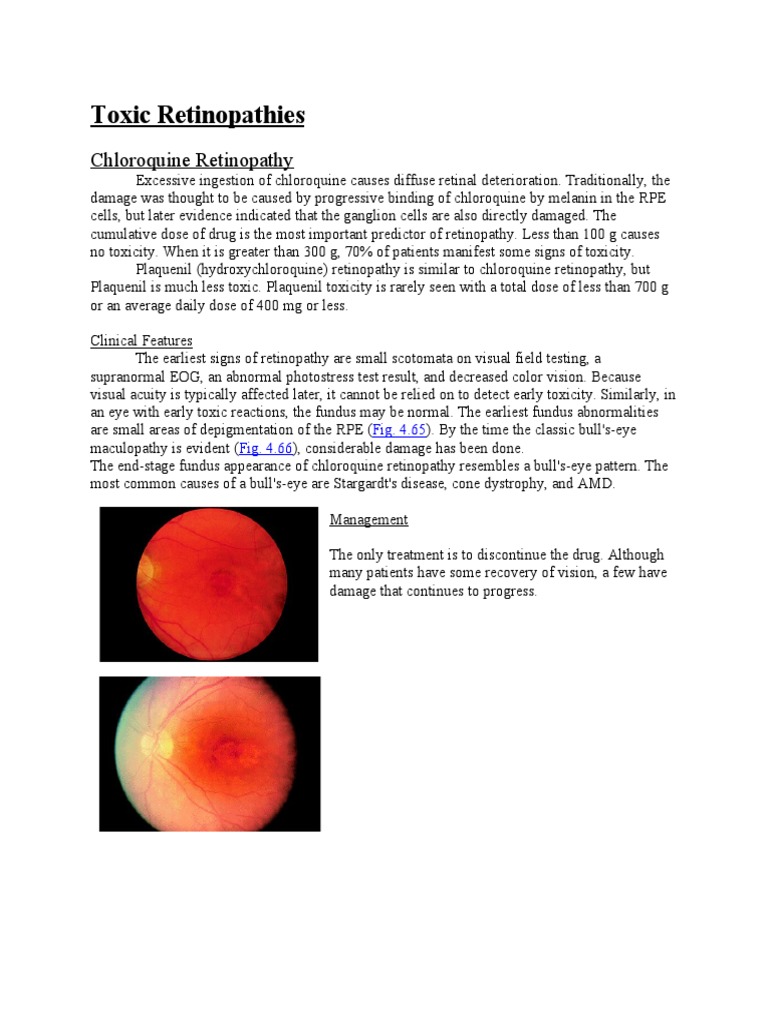 Toxic Retinopathies: Chloroquine Retinopathy | PDF | Human Eye | Health ...