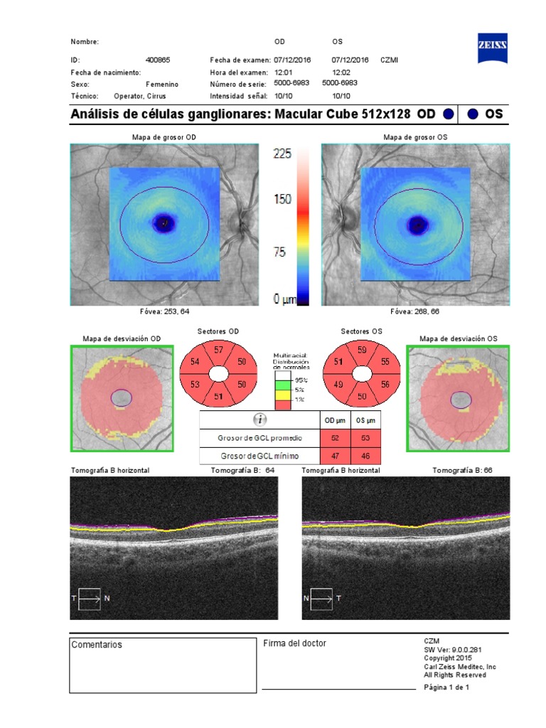 Análisis de Células Ganglionares - Macular Cube 512x128 | PDF | Visión ...