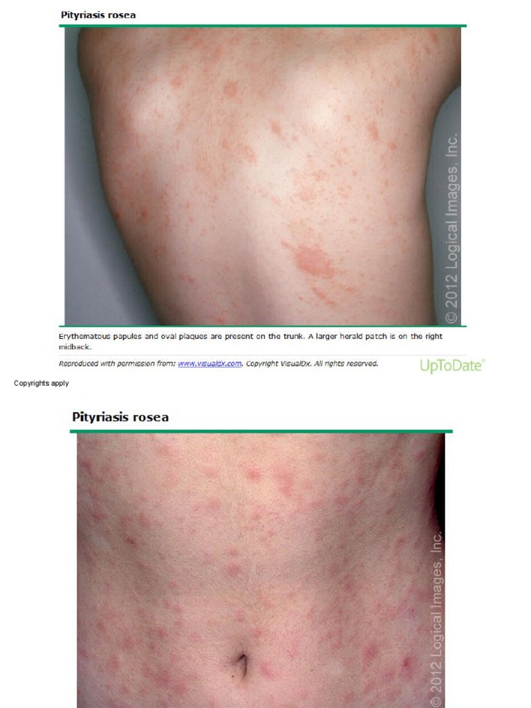 Pityriasis Rosea With Herald Patch | PDF